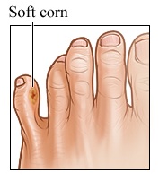 Soft Corns Between the Toes: Causes and Remedies | New Health Advisor