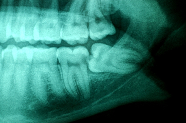 When to Remove Wisdom Teeth Growing In | New Health Advisor