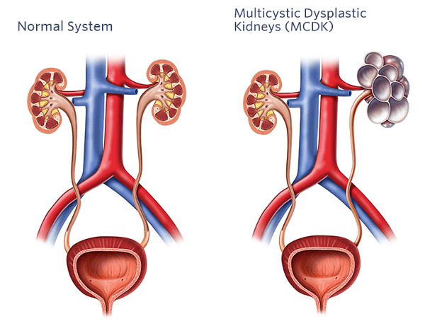 What Is Multicystic Dysplastic Kidney? | New Health Advisor