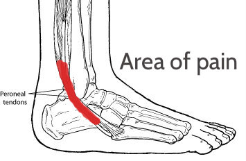 Peroneal Tendonitis and Running | New Health Advisor