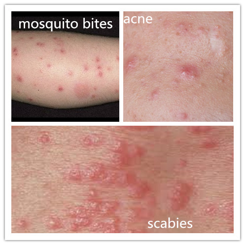 What Do Scabies Look Like? | New Health Advisor