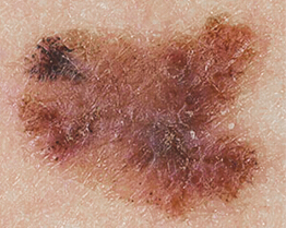 Cancerous Moles Early Signs | New Health Advisor
