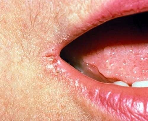 Angular Cheilitis Causes | New Health Advisor