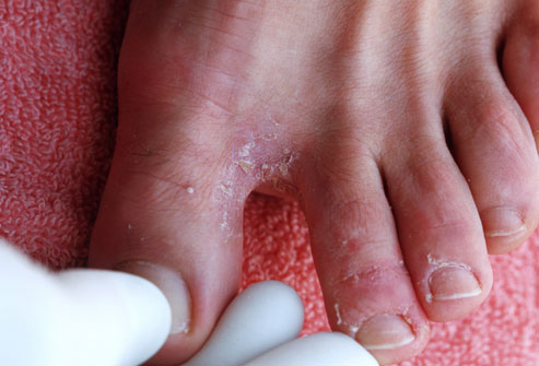 Blisters Between Toes | New Health Advisor