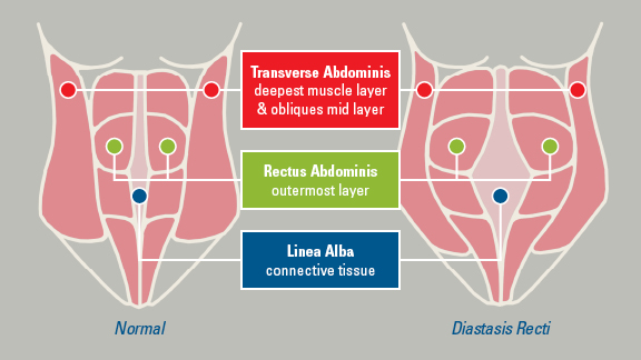 Causes and Treatments of Diastasis Recti Among Men | New Health Advisor