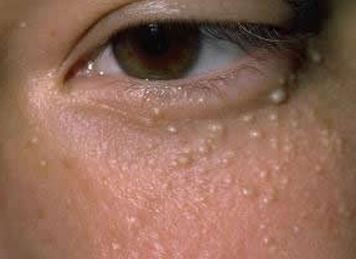 What Are the White Spots Under Eyes? | New Health Advisor