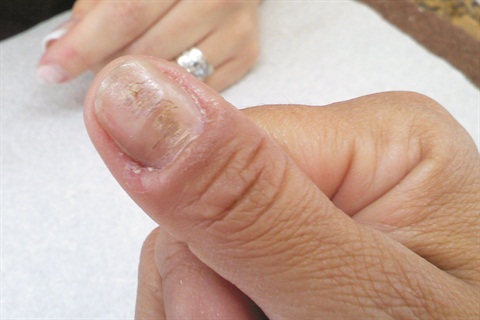 What Causes Horizontal Ridges on Nails? | New Health Advisor