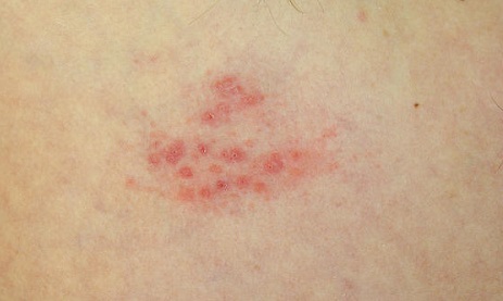 Bumps on Inner Thighs | New Health Advisor