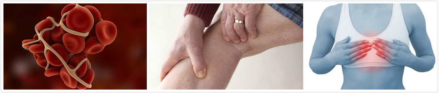 What Does a Blood Clot Feel Like? | New Health Advisor