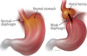 Hiatal Hernia Surgery | New Health Advisor