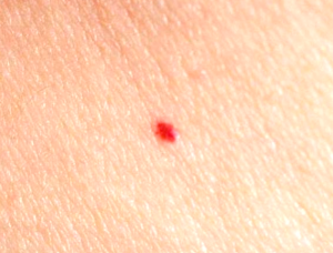 What Causes Little Red Dot on the Skin? | New Health Advisor