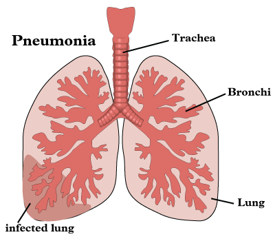 Can You Catch Pneumonia? | New Health Advisor