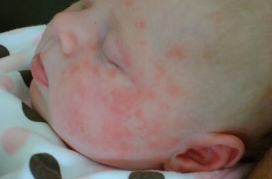 What Is Milk Protein Intolerance? | New Health Advisor