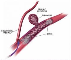 Splenic Artery Aneurysm | New Health Advisor