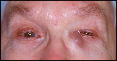 Blocked Tear Duct in Adult | New Health Advisor