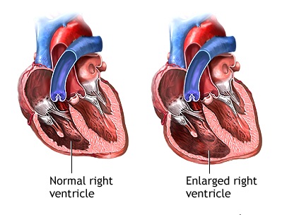 Tricuspid Regurgitation: Causes, Symptoms, Treatment | New Health Advisor