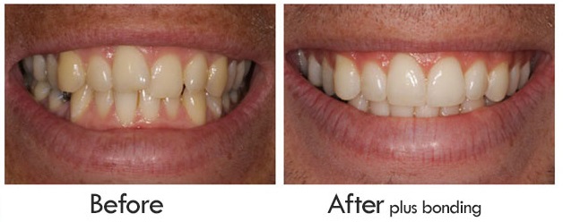 Retainer Before and After | New Health Advisor
