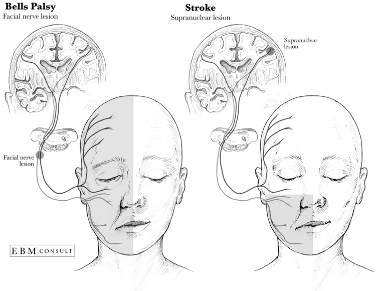 Bell's Palsy vs. Stroke | New Health Advisor