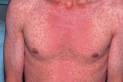 How to Prevent Measles in 4 Ways | New Health Advisor