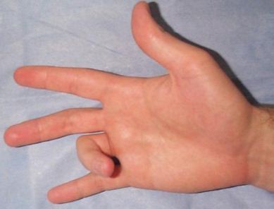 Trigger Finger Causes | New Health Advisor
