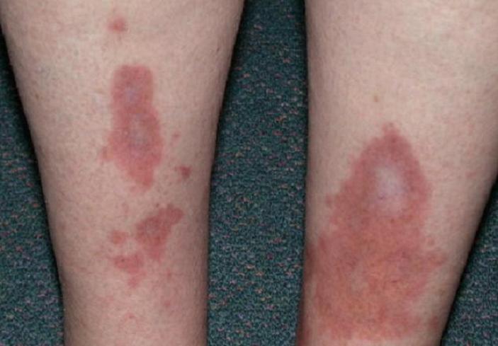 Erythema Nodosum Pictures | New Health Advisor