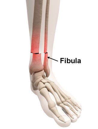 Fibula Stress Fracture: Symptoms, Treatment and Prevention | New Health ...