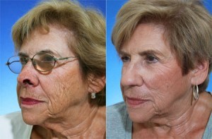 Mohs Surgery Pictures | New Health Advisor