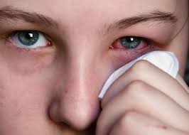 6 Causes Behind Eyes Watering and Burning | New Health Advisor