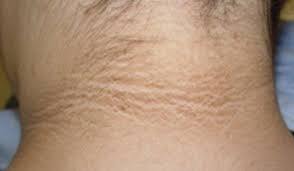 What Causes That Dark Ring Around Neck? | New Health Advisor