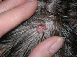 Painful Pimples on Scalp: Causes, Treatments & Preventions | New Health ...