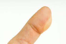 How to Deal with Burn Blister on Finger | New Health Advisor
