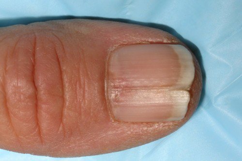 Why Are Your Nails Splitting Down Middle? | New Health Advisor