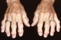 Signs and Treatments for Osteoarthritis in Fingers | New Health Advisor