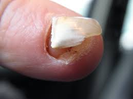 Fingernail Falling Off | New Health Advisor