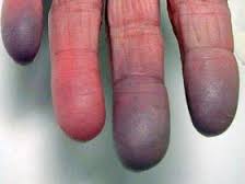 Poor Circulation in Fingers | New Health Advisor