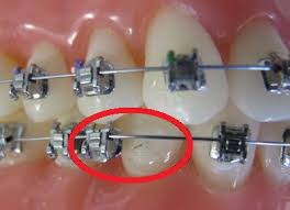 Braces Bracket Came Off | New Health Advisor