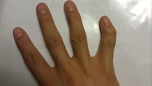 Crooked Little Finger | New Health Advisor