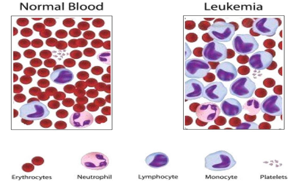 How Does Leukemia Affect the Body? | New Health Advisor