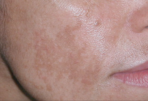 Light Brown Spot in the Skin: Causes and Remedies | New Health Advisor