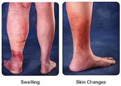 Lower Leg Swelling and Discoloration | New Health Advisor
