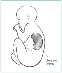 Enlarged Kidney in Fetus | New Health Advisor
