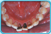 Why Do I Have Black Stains on Teeth? | New Health Advisor