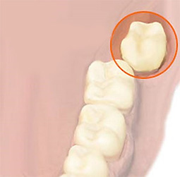 Wisdom Teeth Growing Sideways | New Health Advisor