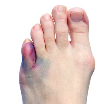Broken Toe Not Healing: What to Do? | New Health Advisor