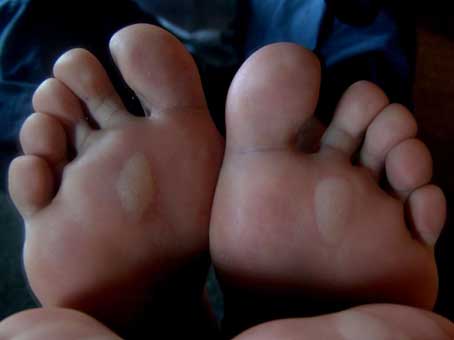 What Causes Blisters On Feet? | New Health Advisor