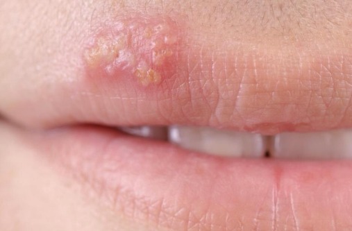 What Causes Fever Blisters? | New Health Advisor