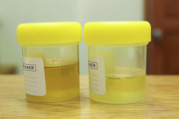 Is It Normal to Have Urine in Bright Yellow Color? | New Health Advisor
