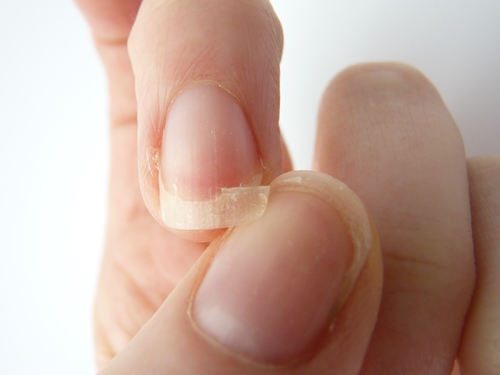 Brittle Nails Vitamin Deficiency | New Health Advisor