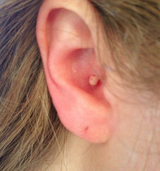 How to Get Rid of a Pimple in Ear | New Health Advisor