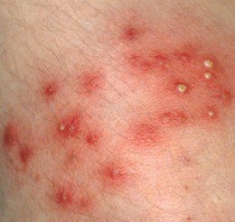 5 Common Treatments for Staph Infection and Prevention Tips | New ...